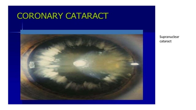 Congenital cataract | PPTX