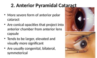 Congenital Cataract (Pediatric cataract and epidemology in Nepal) | PPTX