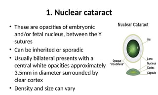 Congenital Cataract (Pediatric cataract and epidemology in Nepal) | PPTX