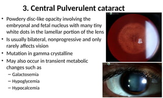 Congenital Cataract (Pediatric cataract and epidemology in Nepal) | PPTX
