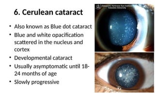 Congenital Cataract (Pediatric cataract and epidemology in Nepal) | PPTX