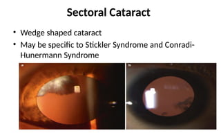 Congenital Cataract (Pediatric cataract and epidemology in Nepal) | PPTX