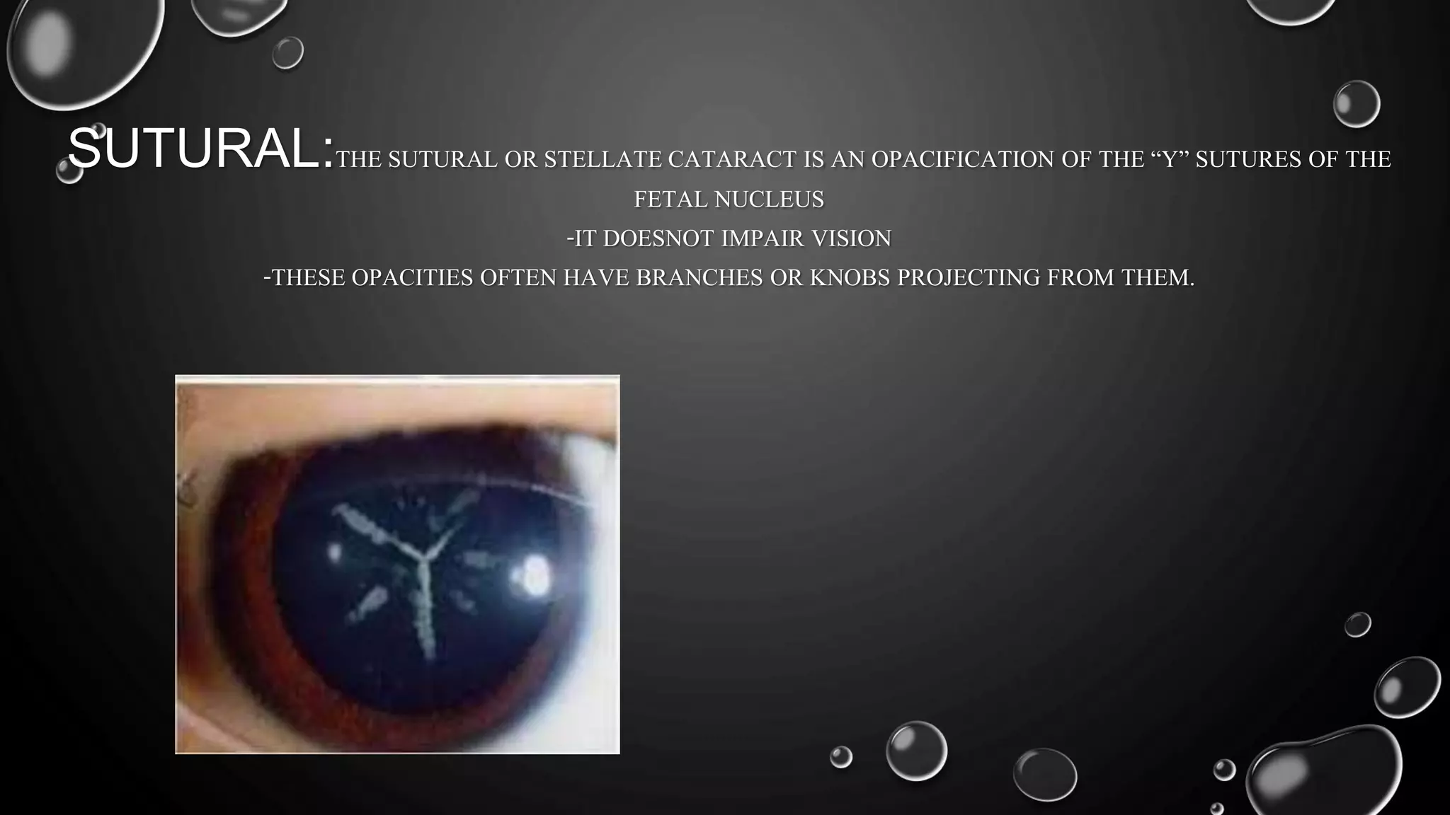 Congenital cataract & ITS MANAGEMENT | PPTX