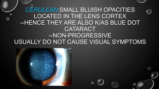 Congenital cataract & ITS MANAGEMENT | PPTX