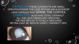 Congenital cataract & ITS MANAGEMENT | PPTX
