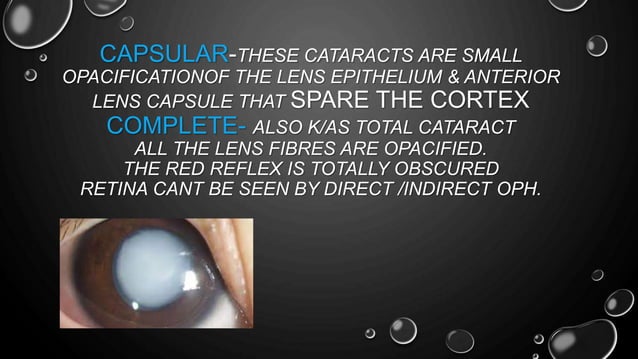 Congenital cataract & ITS MANAGEMENT | PPTX | Eye and Vision Conditions ...