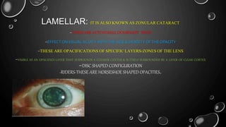Congenital cataract & ITS MANAGEMENT | PPTX