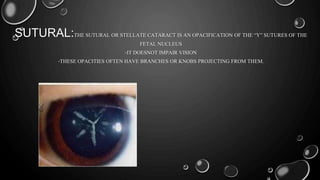 Congenital cataract & ITS MANAGEMENT | PPTX
