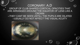 Congenital cataract & ITS MANAGEMENT | PPTX