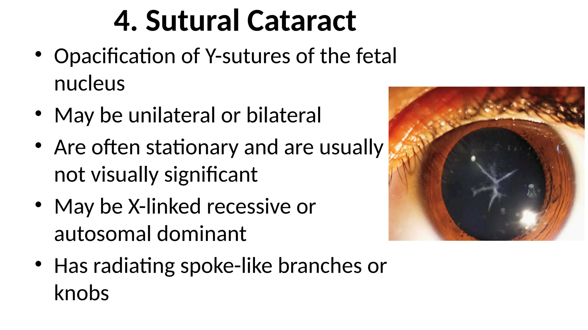 Congenital Cataract, Dr. Prabhat Devkota.pptx