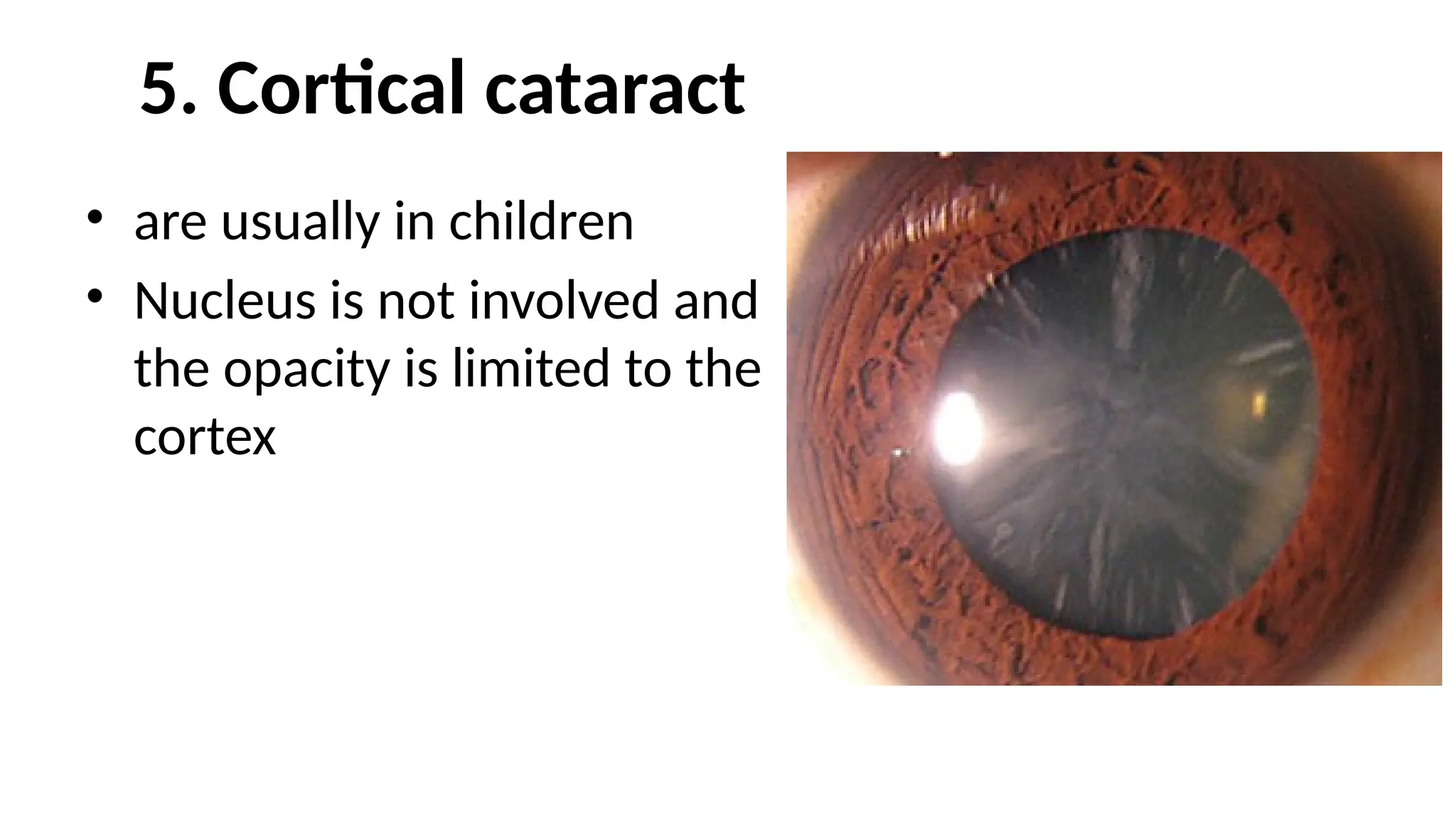 Congenital Cataract, Dr. Prabhat Devkota.pptx