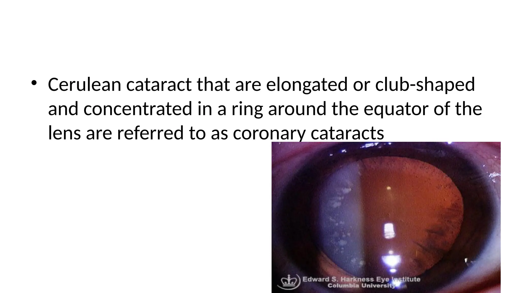 Congenital Cataract, Dr. Prabhat Devkota.pptx