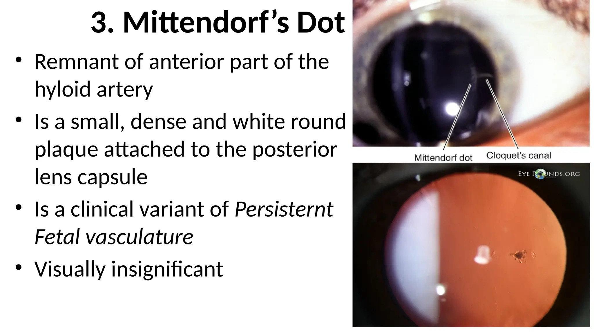 Congenital Cataract, Dr. Prabhat Devkota.pptx