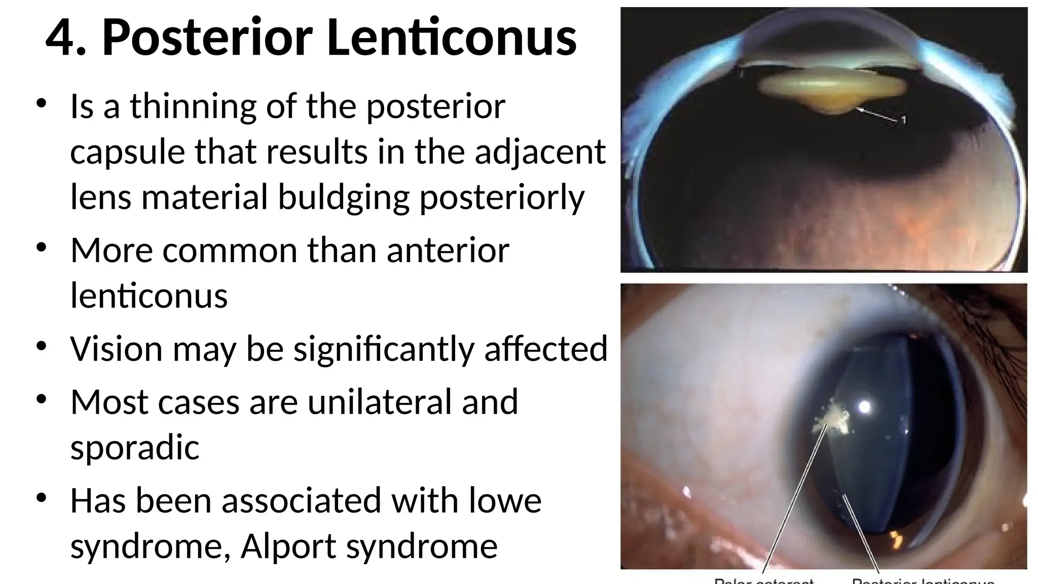Congenital Cataract, Dr. Prabhat Devkota.pptx