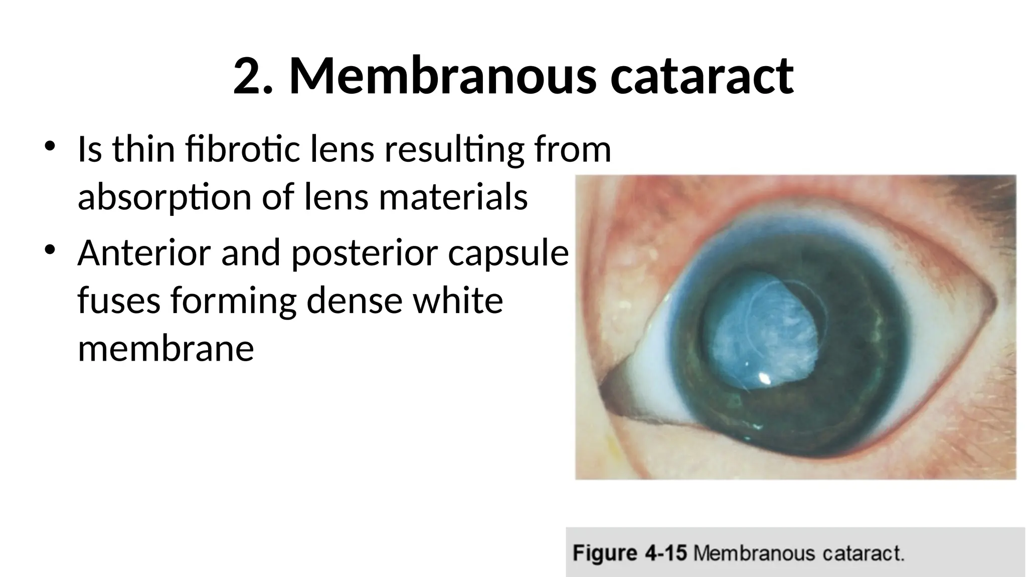 Congenital Cataract, Dr. Prabhat Devkota.pptx