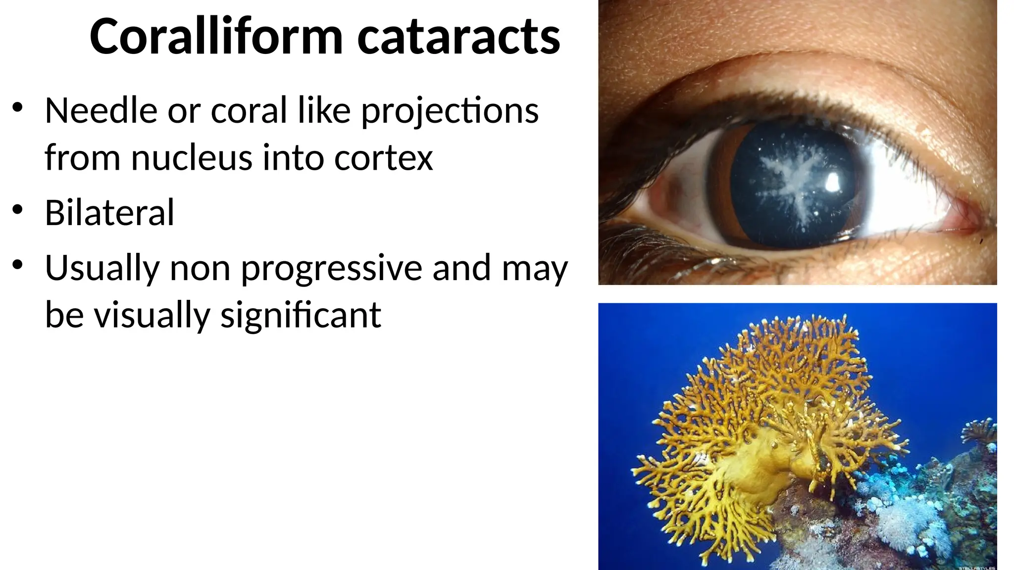 Congenital Cataract, Dr. Prabhat Devkota.pptx
