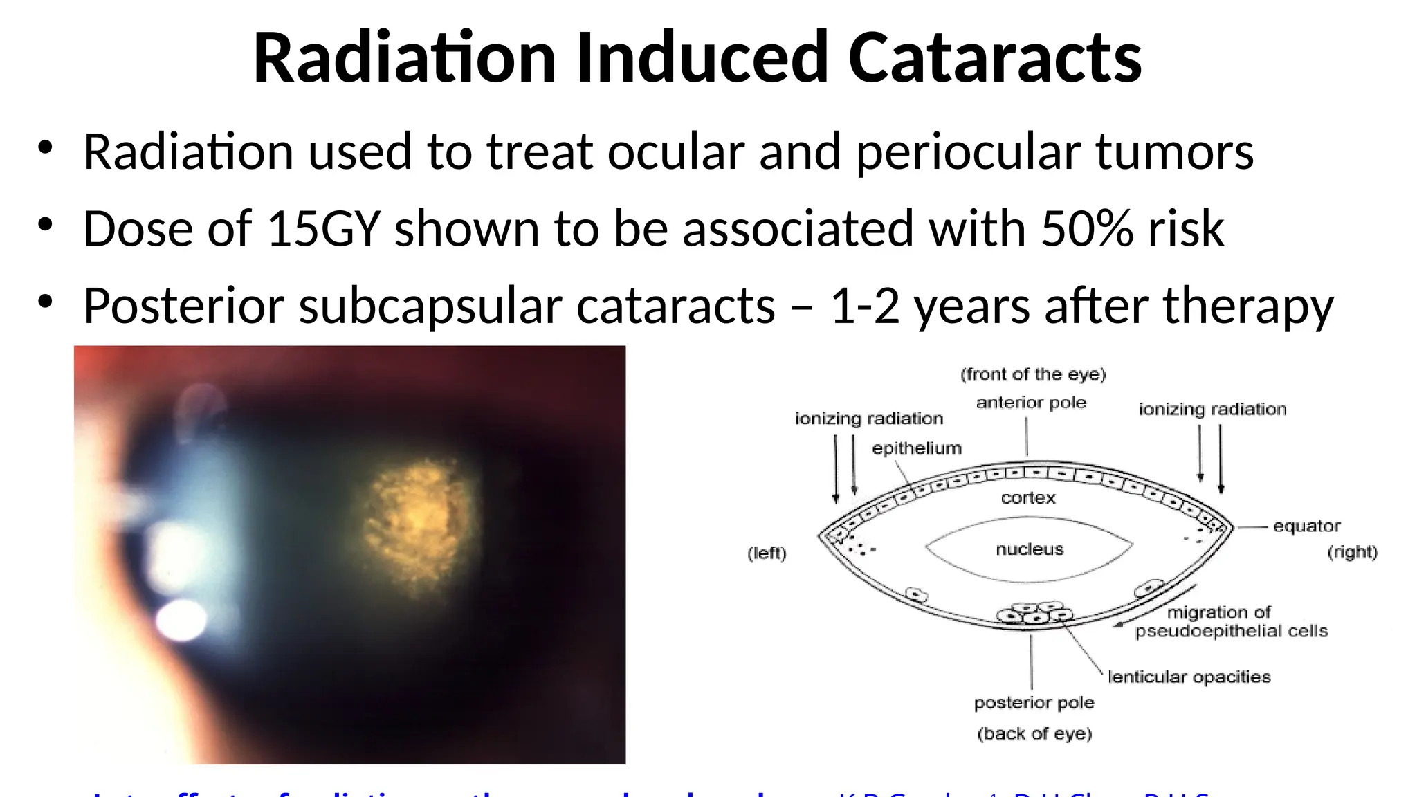 Congenital Cataract, Dr. Prabhat Devkota.pptx