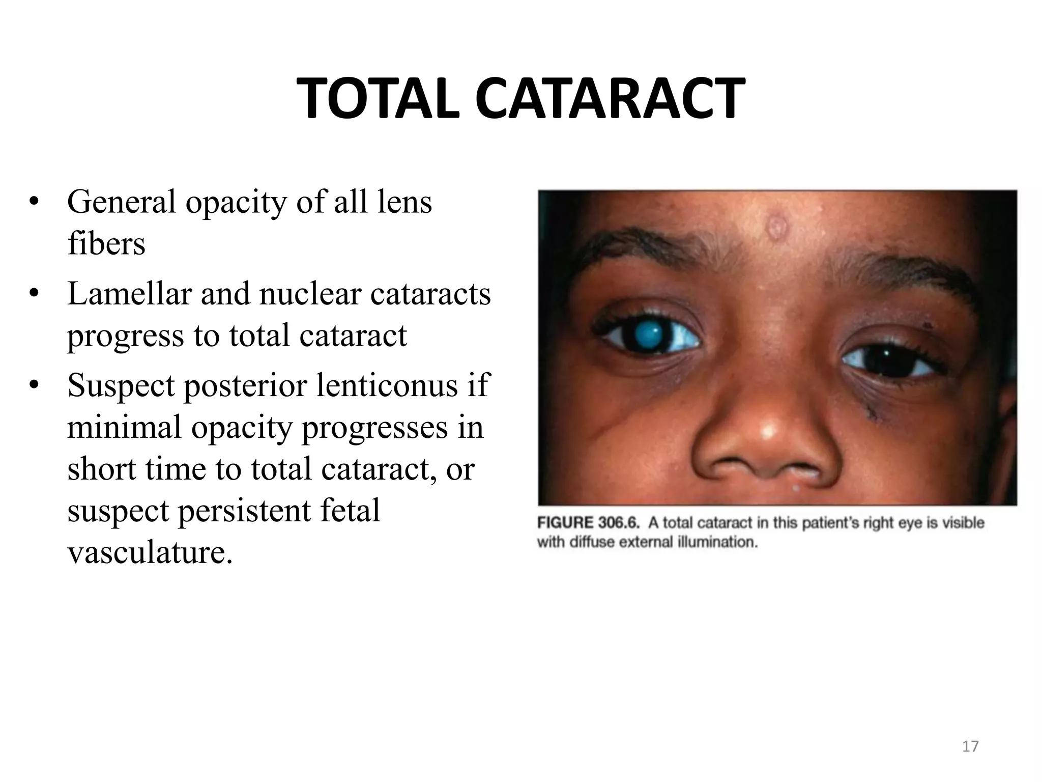 Congenital cataract | PPTX