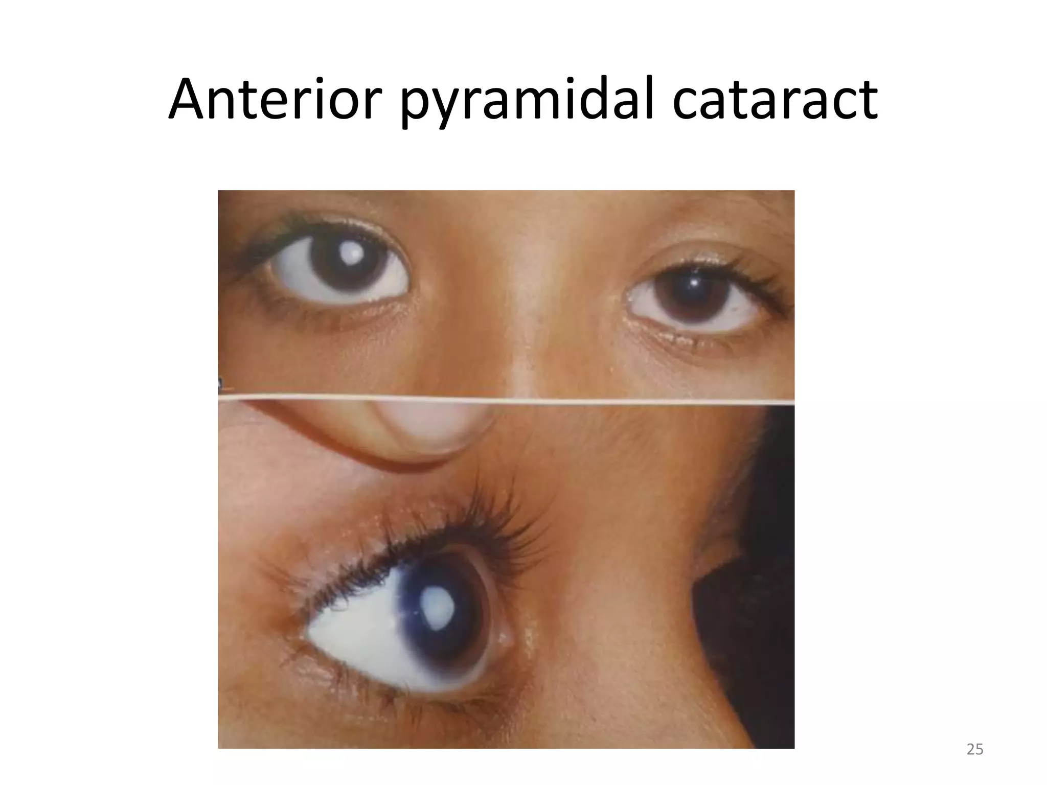 Congenital cataract | PPTX