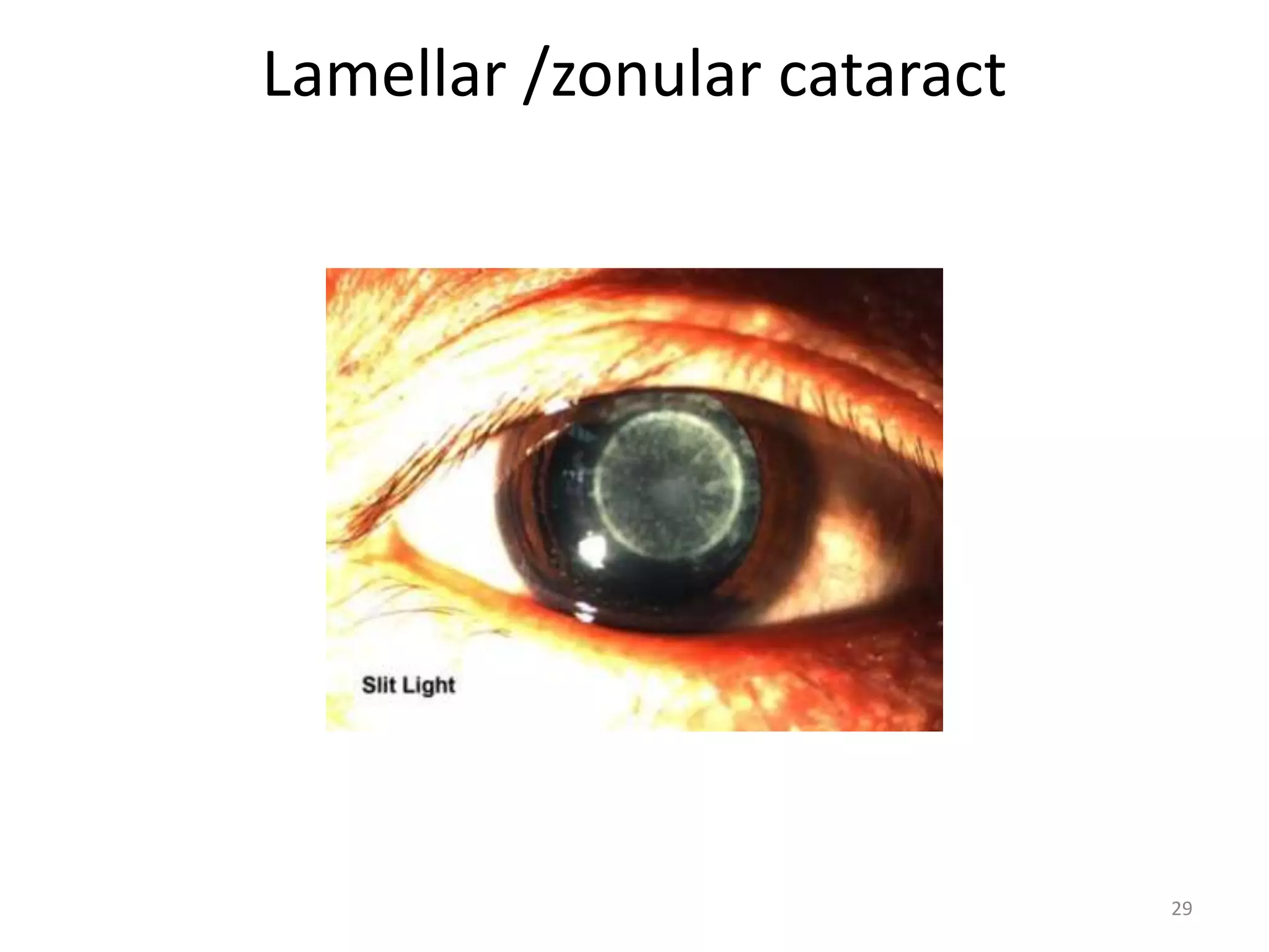 Congenital cataract | PPTX