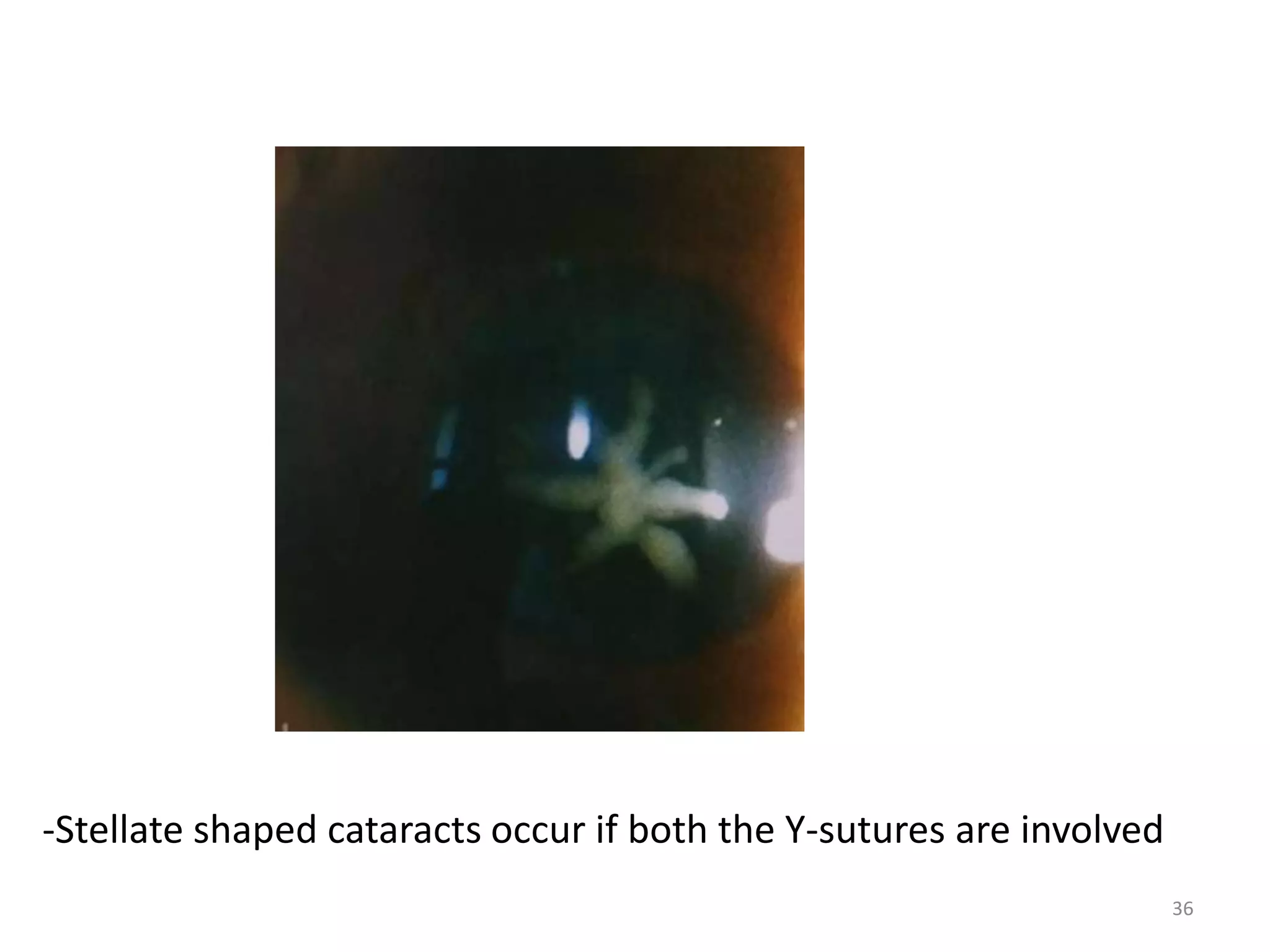 Congenital cataract | PPTX