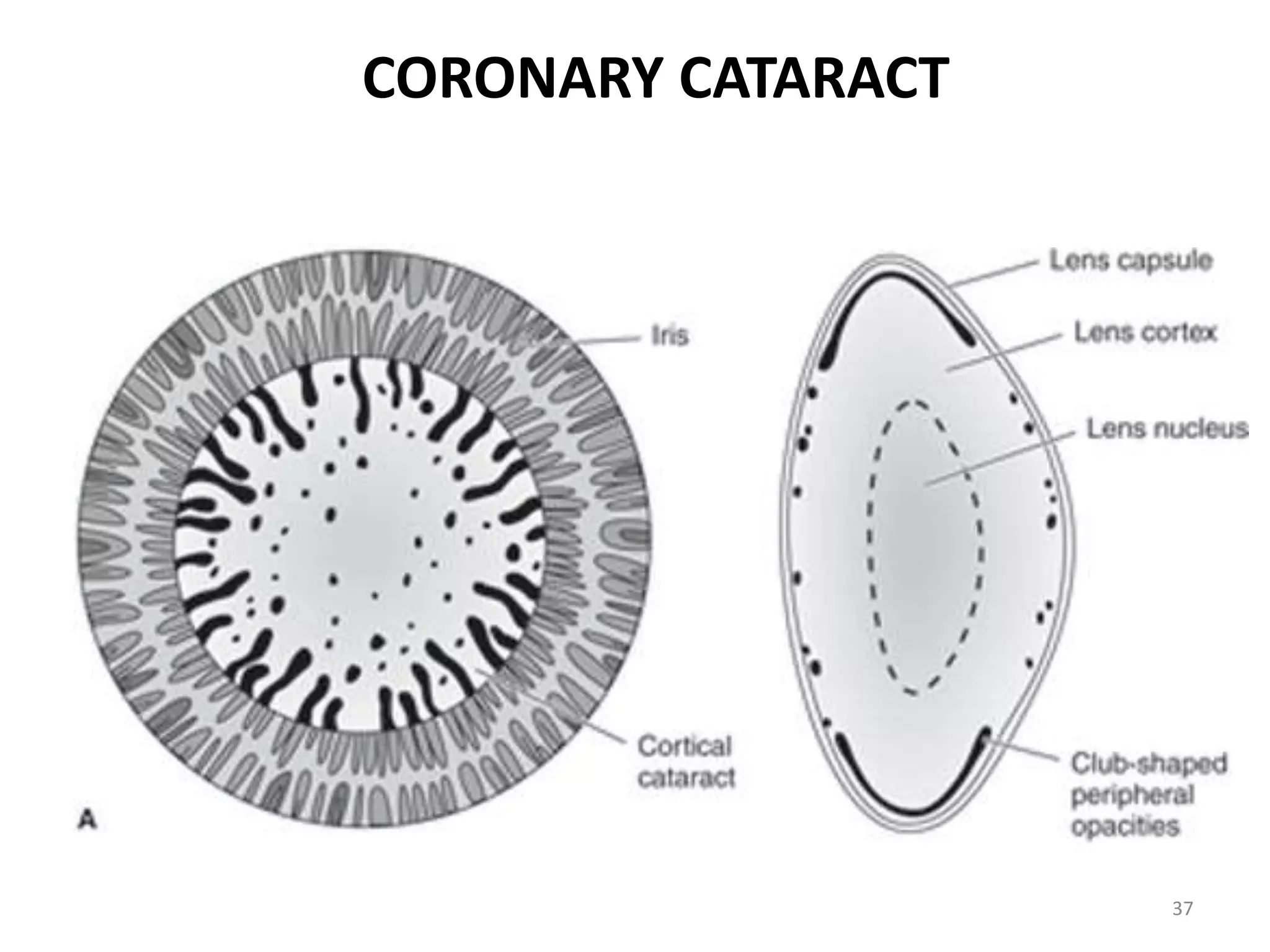Congenital cataract | PPTX