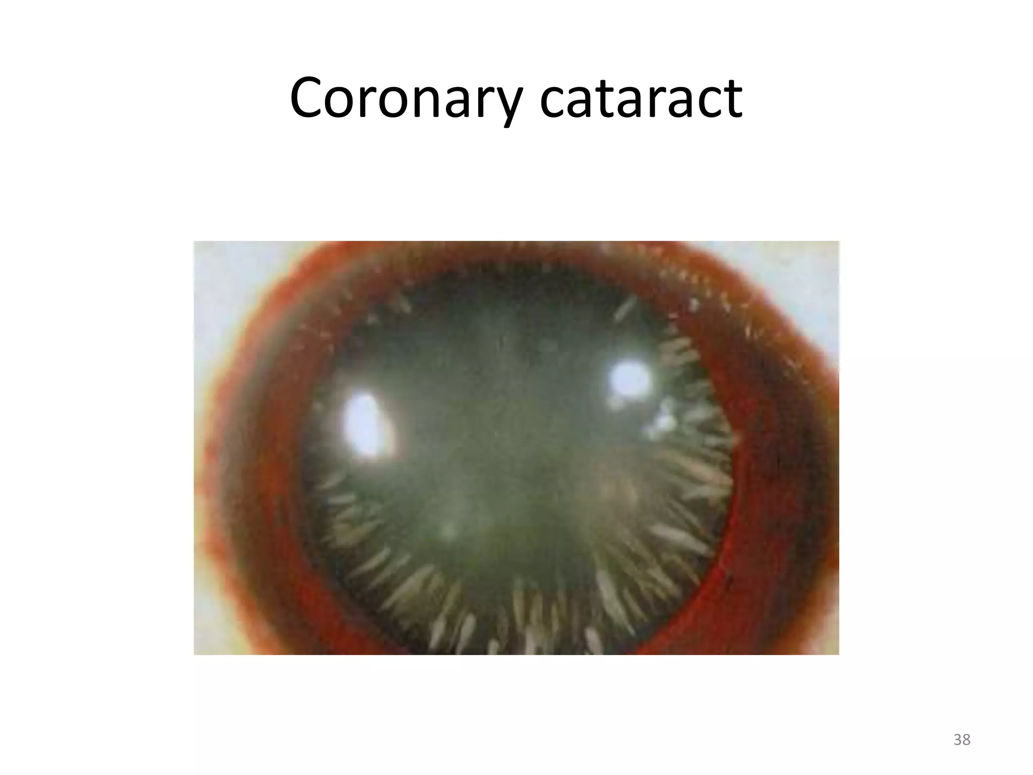 Congenital cataract | PPTX