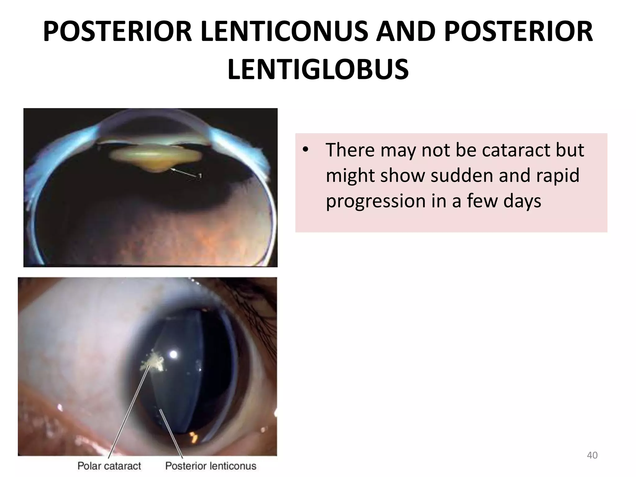 Congenital cataract | PPTX