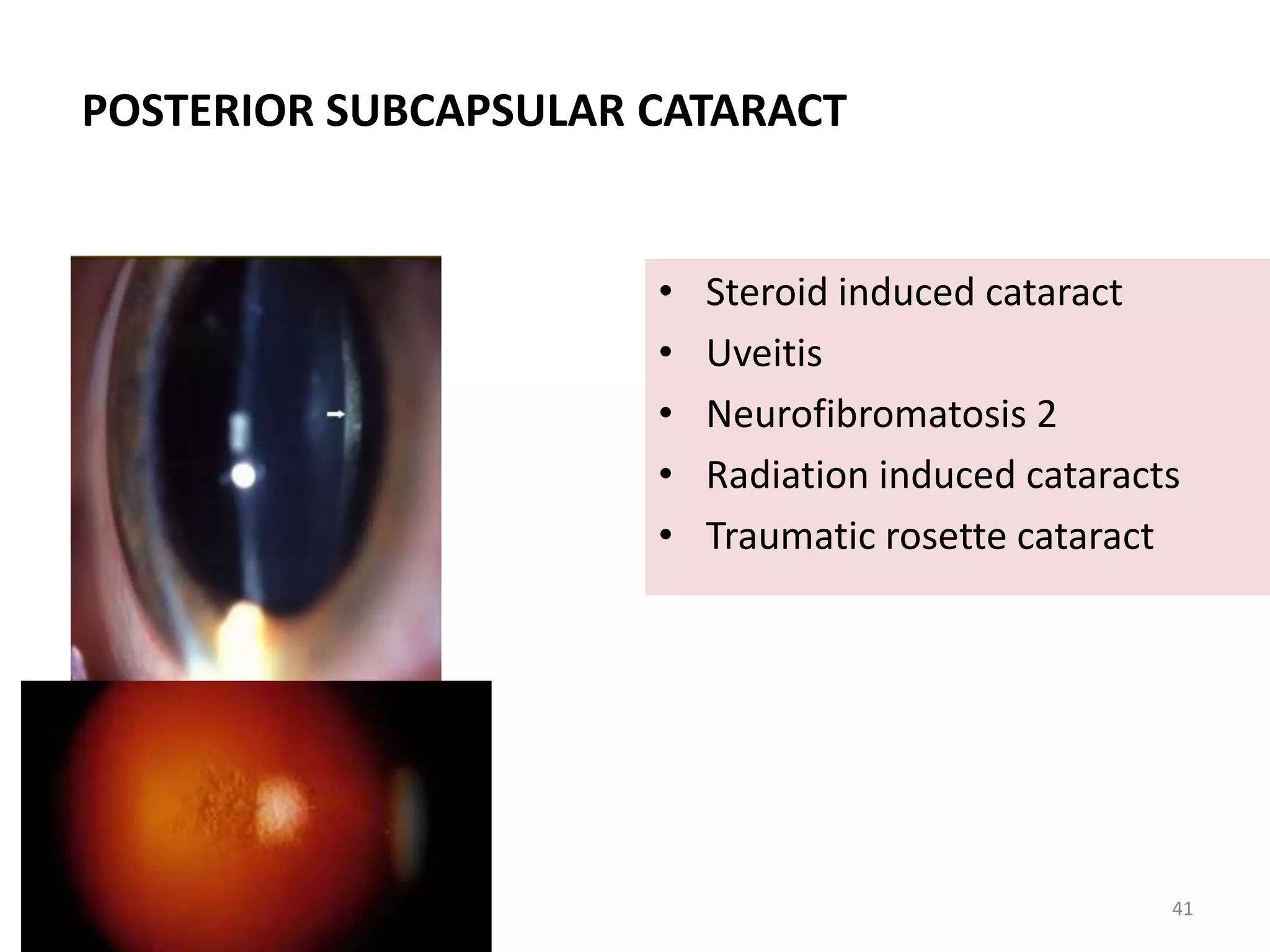 Congenital cataract | PPTX