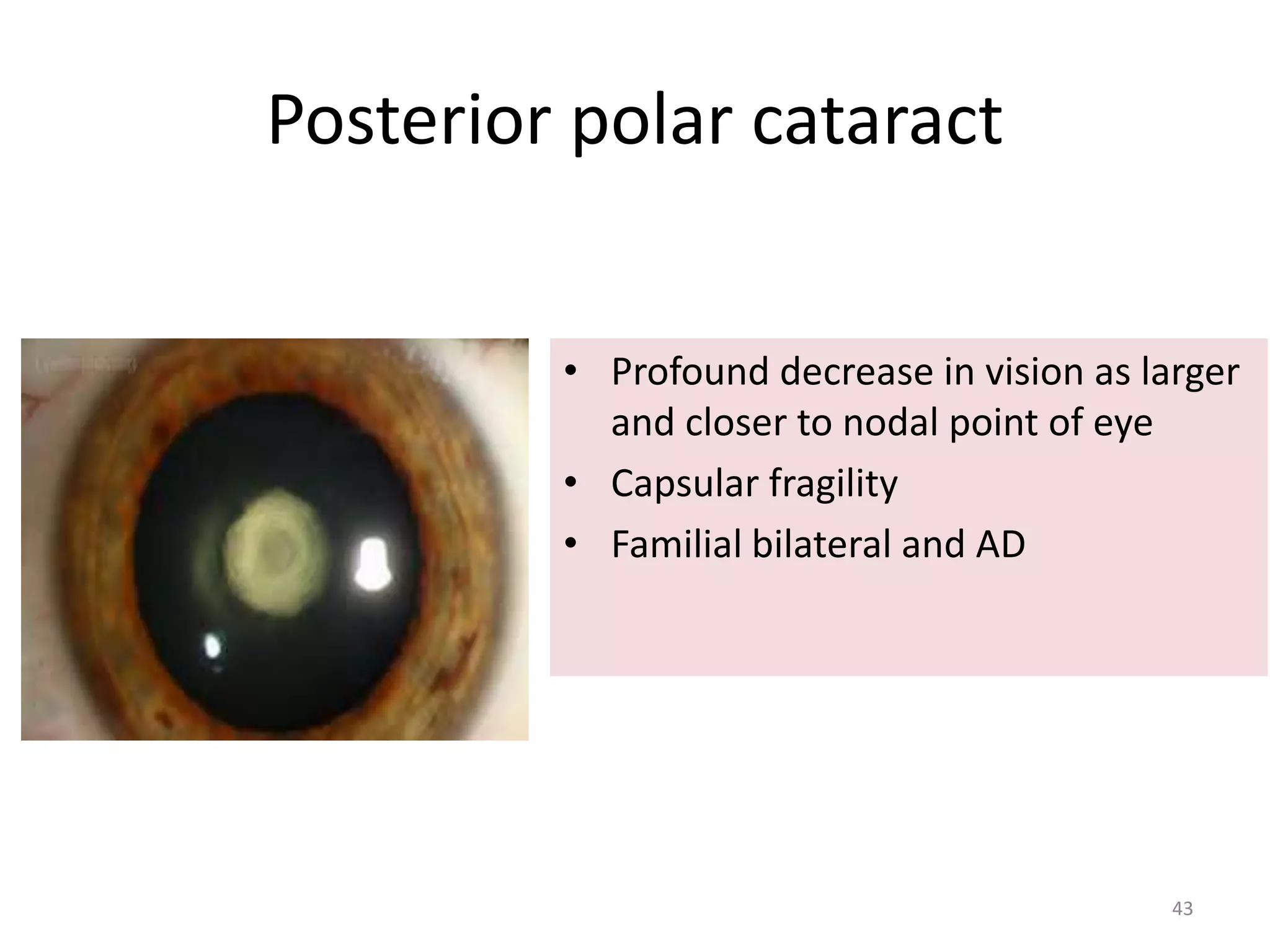Congenital Cataract Pptx
