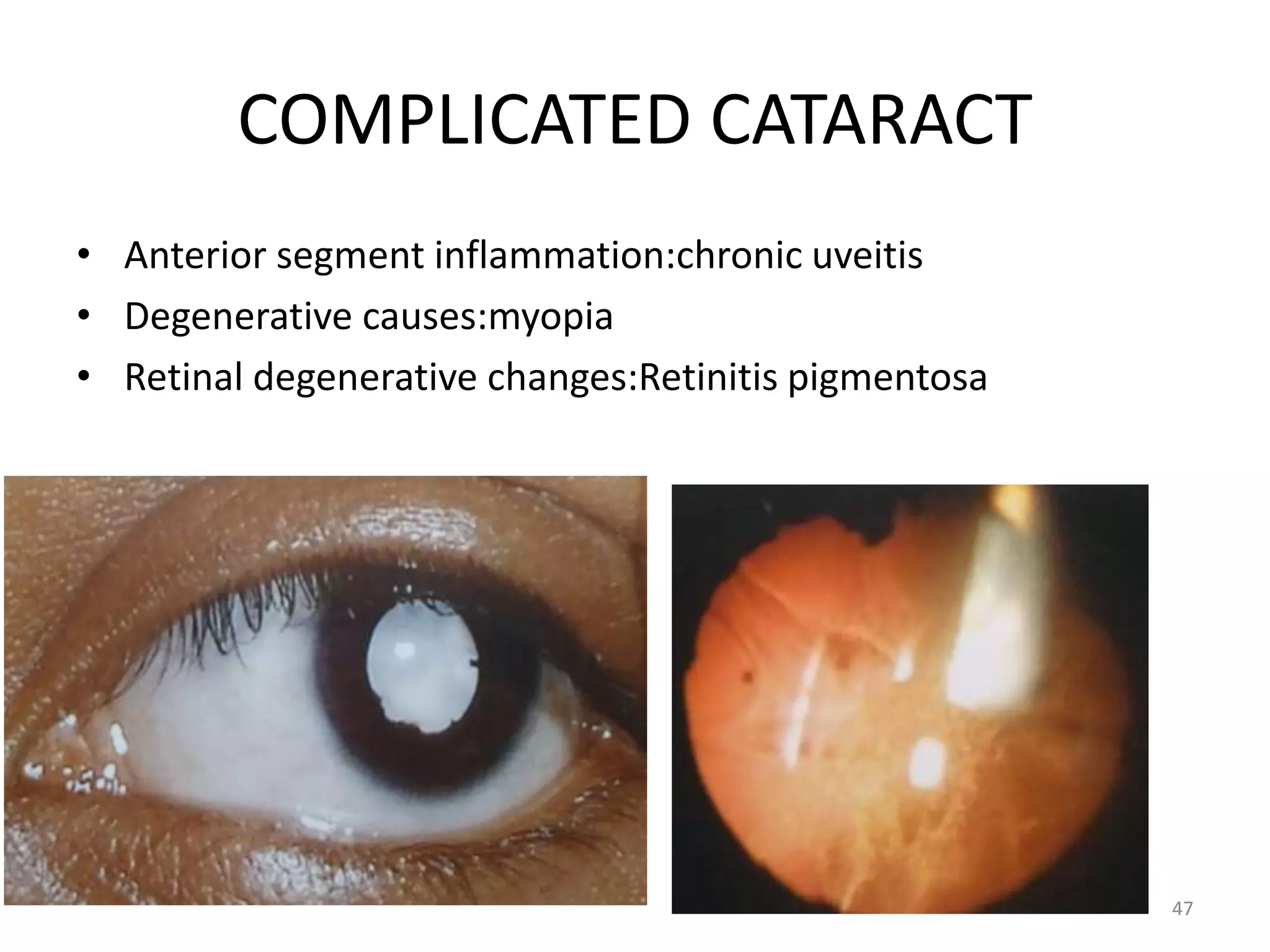 Congenital cataract | PPTX