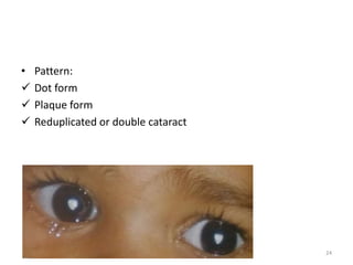Congenital cataract | PPTX