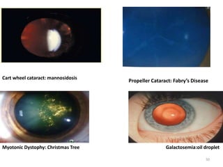 Congenital cataract | PPTX