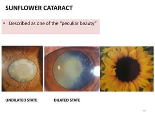 Sunflower Cataract