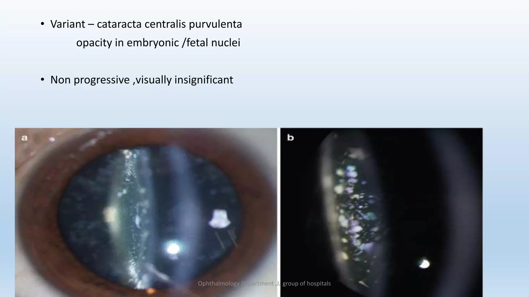 Pediatric (congenital, developmental) cataract and management ...