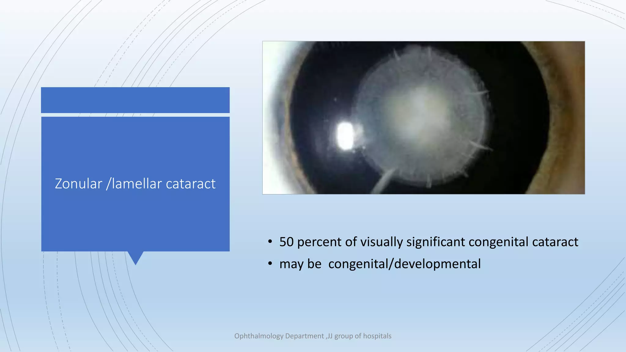 Pediatric Congenital Developmental Cataract And Management Pediatric Ophthalmology Ppt