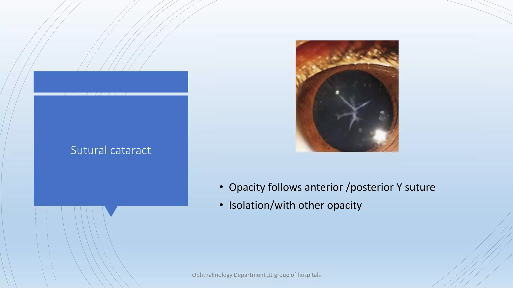 Pediatric (congenital, developmental) cataract and management - pediatric ophthalmology | PPTX ...