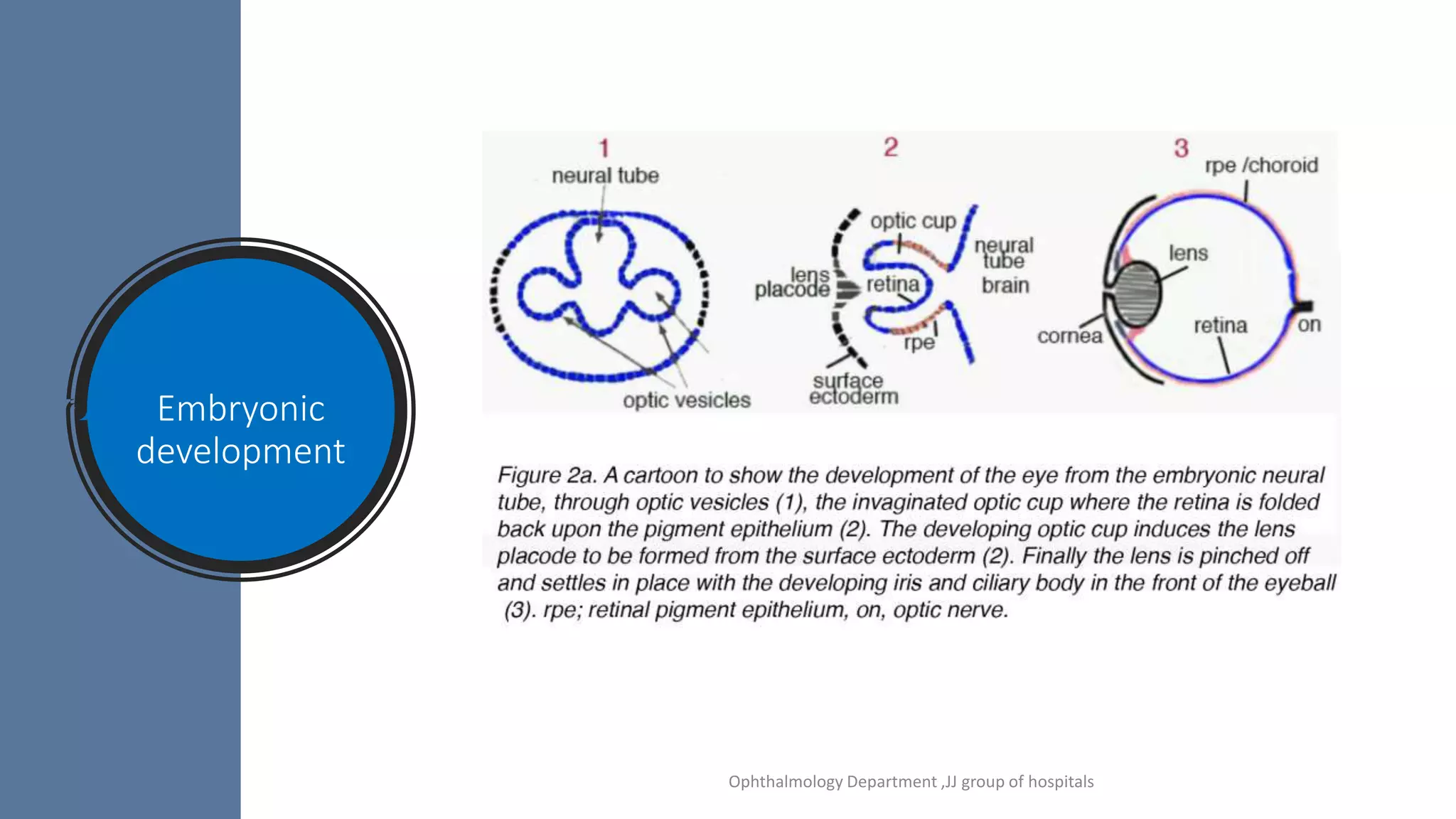 Pediatric (congenital, developmental) cataract and management ...