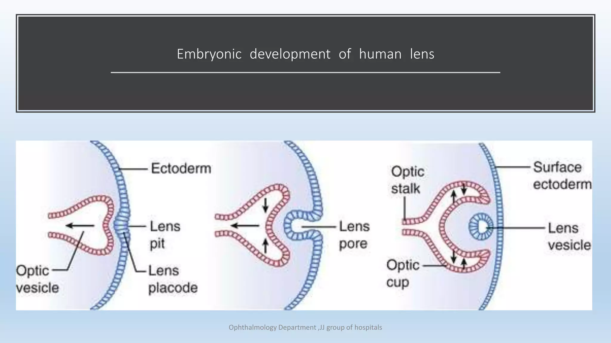 Pediatric (congenital, developmental) cataract and management ...