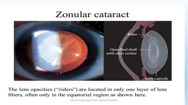 Pediatric (congenital, developmental) cataract and management ...
