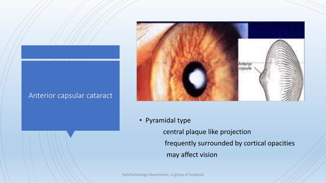 Pediatric (congenital, developmental) cataract and management ...