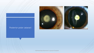 Pediatric (congenital, developmental) cataract and management ...