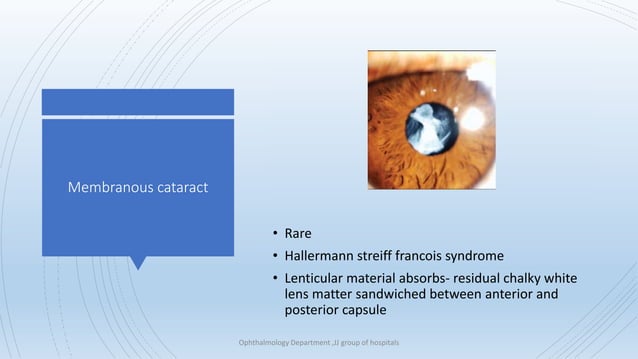 Pediatric (congenital, developmental) cataract and management ...