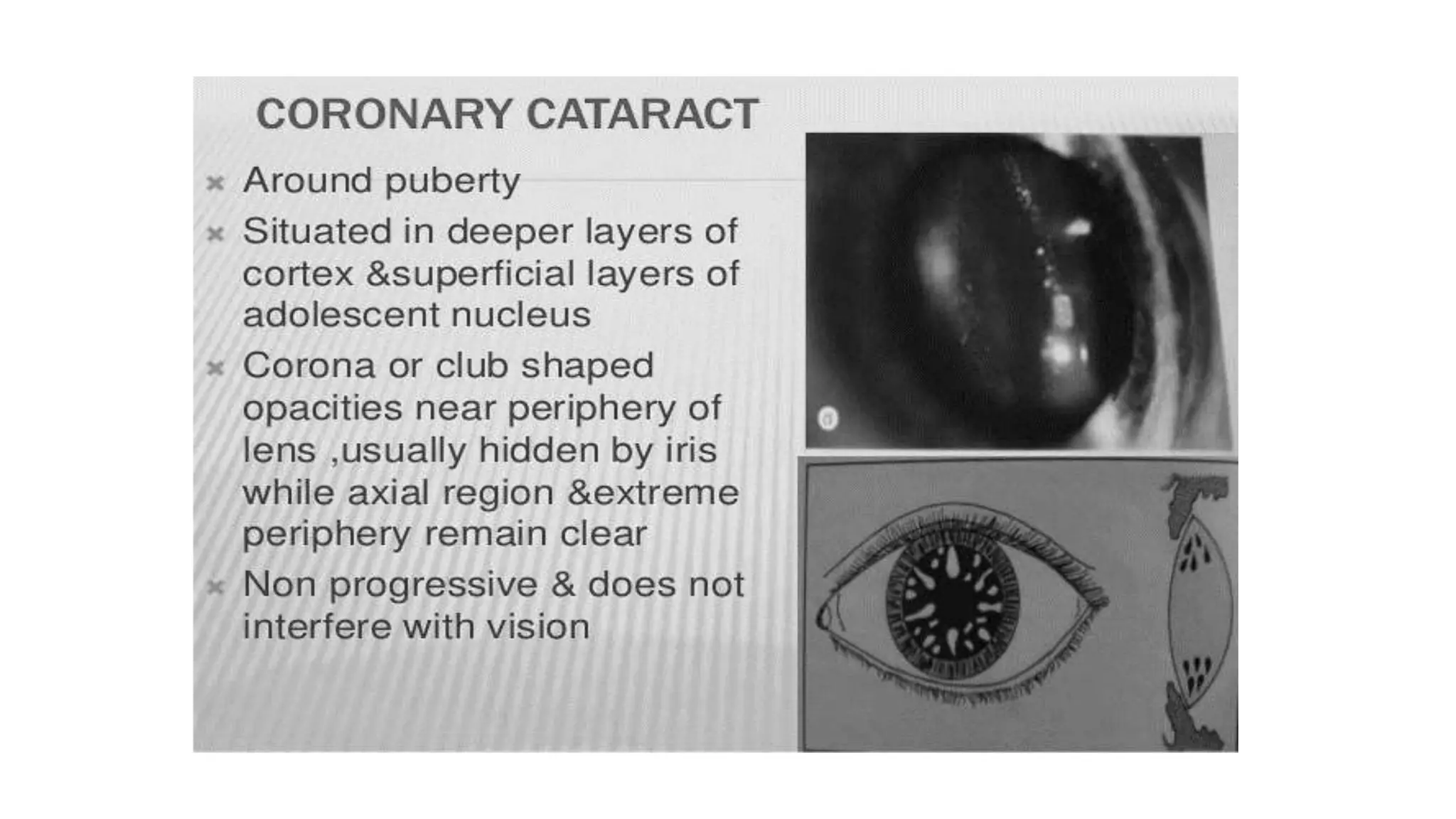 Congenital cataract | PPTX