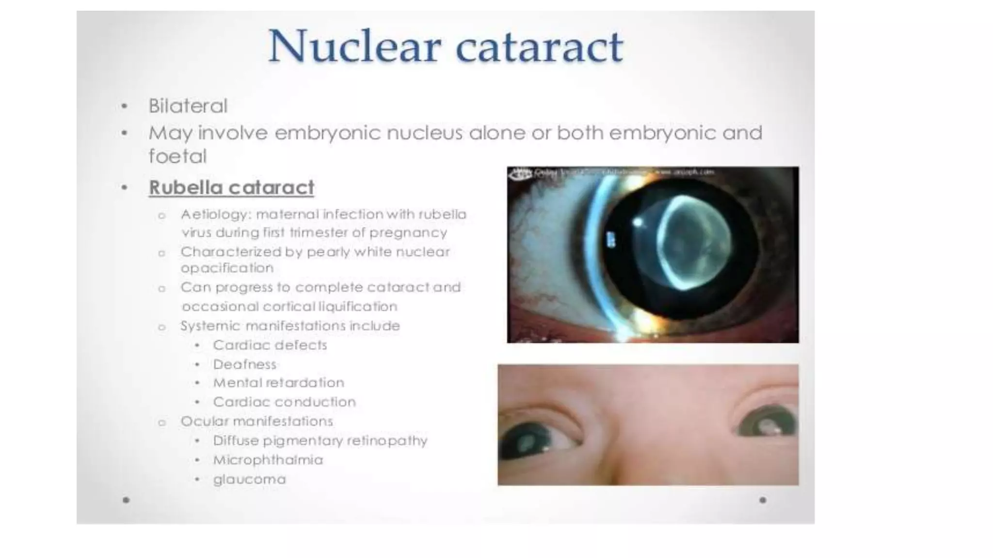 Congenital cataract | PPTX