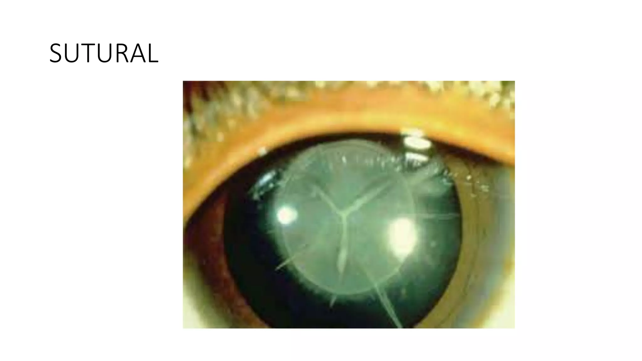 Congenital cataract | PPTX