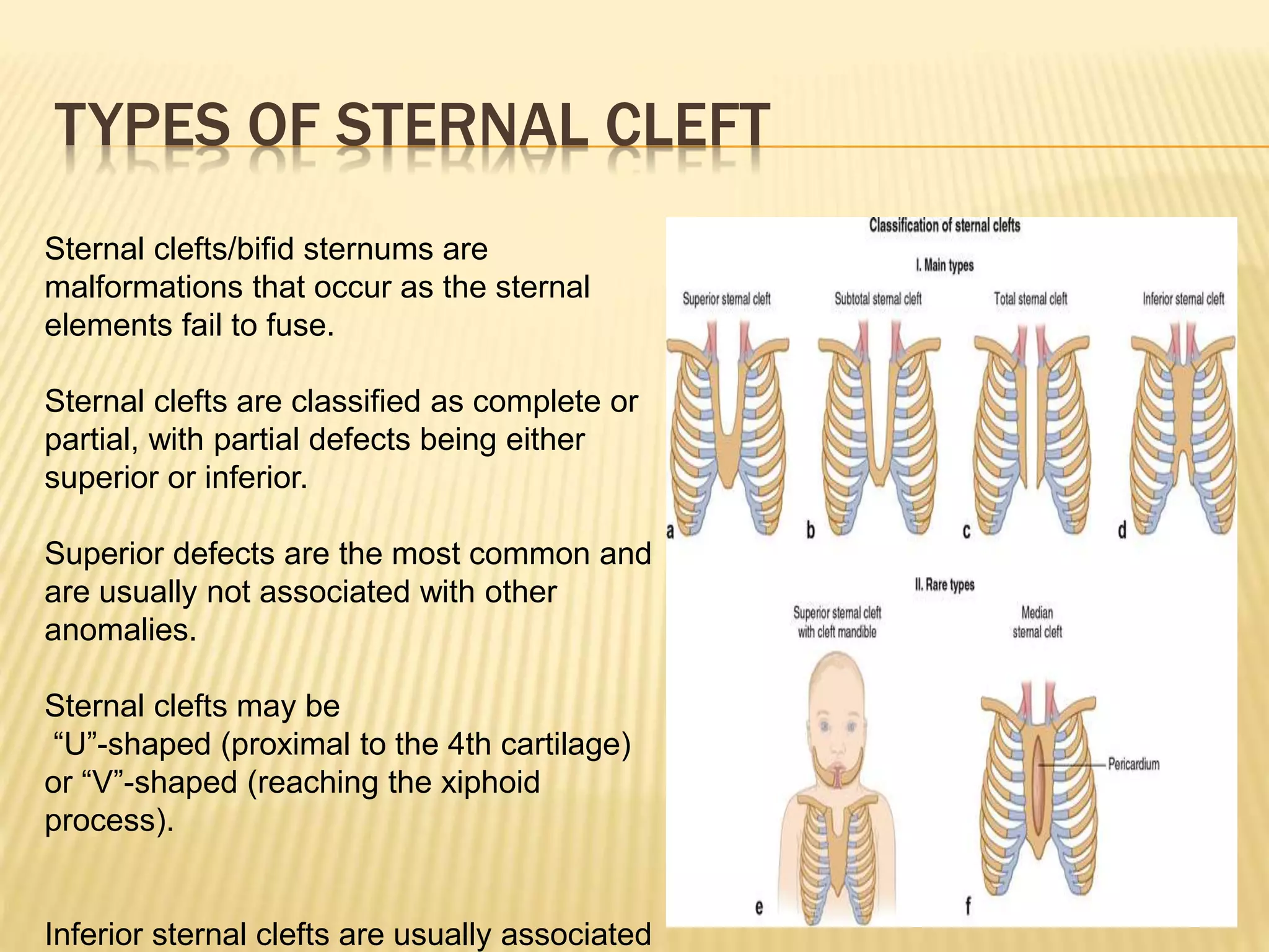 Congenital chest wall anomalies | PPTX