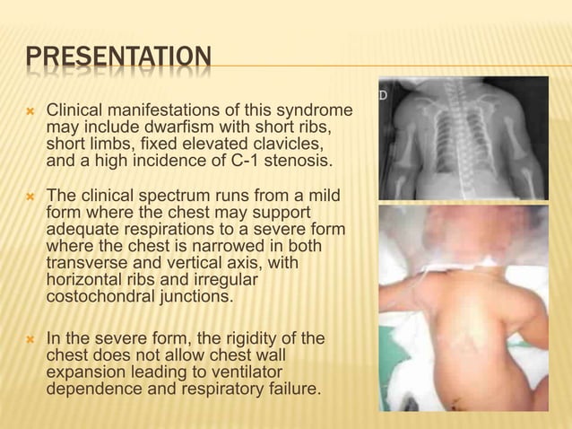 Congenital chest wall anomalies