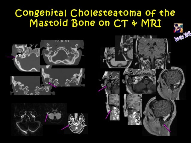 Congenital Cholesteatoma of the Mastoid Bone on CT& MRI