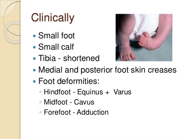 Congenital clubfoot
